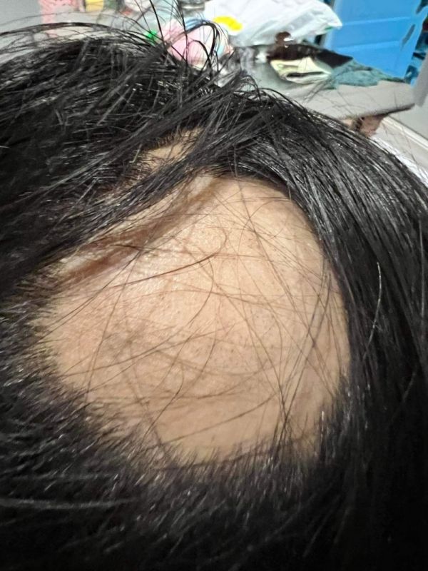 Doctors try to identify mass hair loss on girl, 9