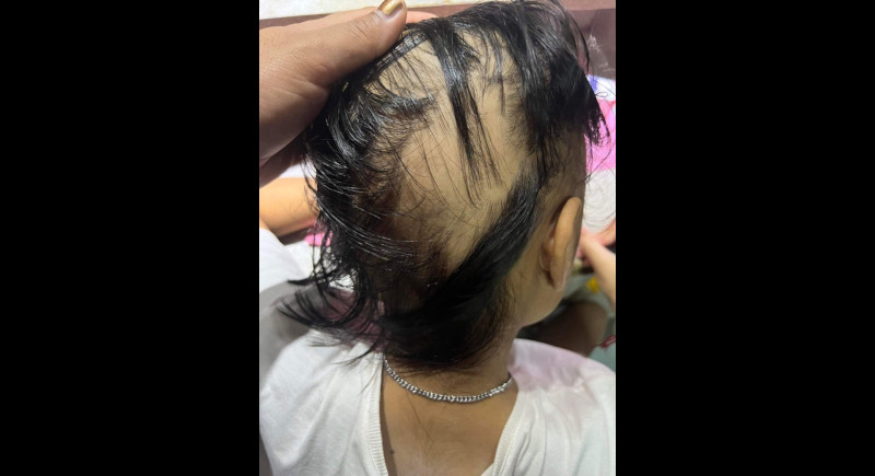 Doctors try to identify mass hair loss on girl, 9